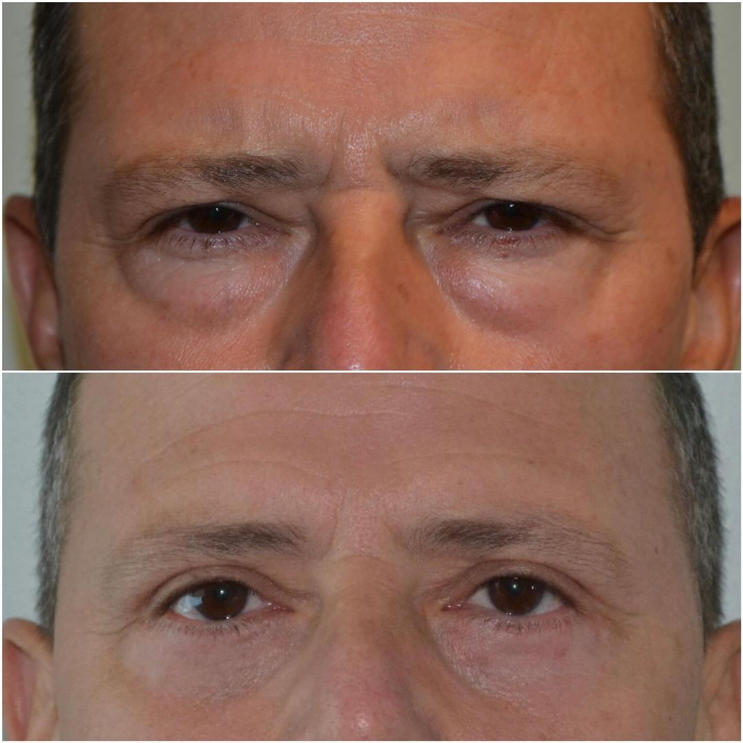 Gallery Blepharoplasty | Naples Plastic Surgery | Dr. Gardner | Dr. Baccaro